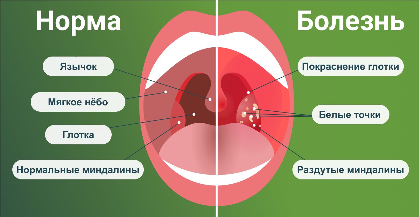 Боль в горле: всё о методах лечения и лекарствах.